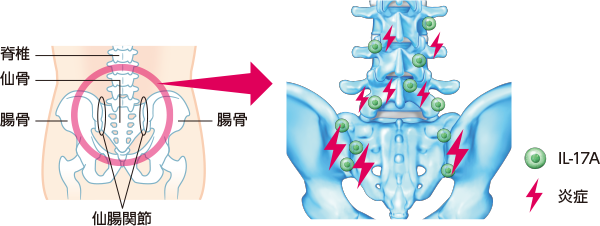 体軸性脊椎関節炎について 体軸性脊椎関節炎（強直性脊椎炎、x線基準を満たさない体軸性脊椎関節炎）の患者さん向け コセンティクス®を使用
