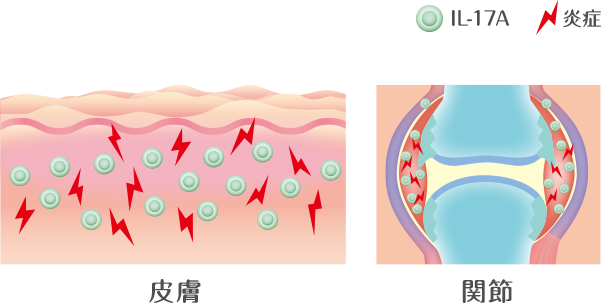 コセンティクスとは 乾癬（尋常性乾癬、乾癬性関節炎、膿疱性乾癬）の患者さん向け コセンティクス®を使用される患者さんへ
